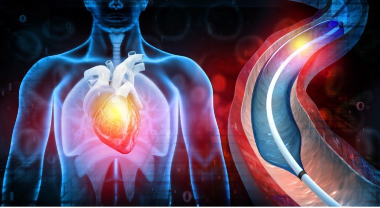 The Role of an Interventional Cardiologist - Consulting Cardiologists